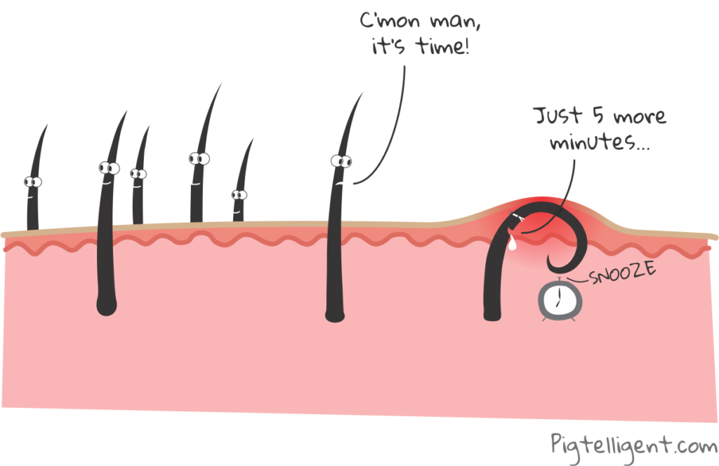 Br 1. prirodno rešenje za problem sa urastanjem dlake