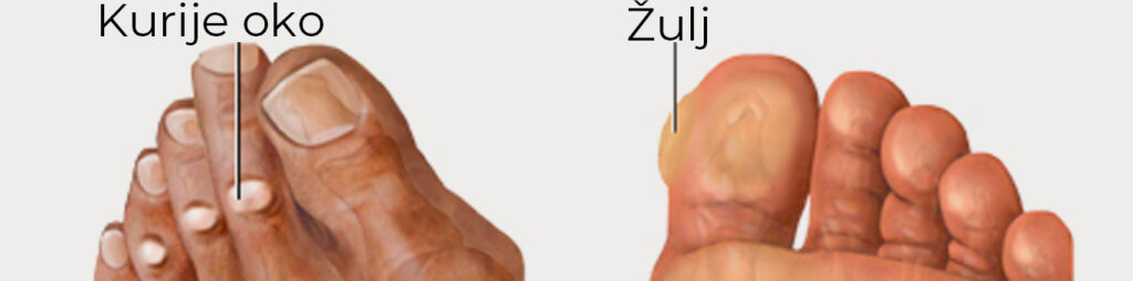 Kako izlečiti kurje oko: Najefikasnije i brze metode