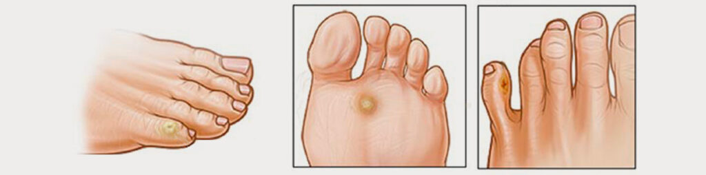 Kako izlečiti kurje oko: Najefikasnije i brze metode